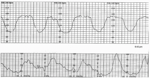 Managing Uterine Tachysystole Associated with Oxytocin Use - KAMMCO